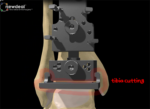 TARA (total ankle replacement arthroplasty) : 네이버 블로그