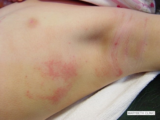 164. 연속종피부염 (물렁종피부염, 軟屬腫皮膚炎, Molluscum dermatitis) - 피부질환 백과사전﻿﻿ : 네이버 블로그