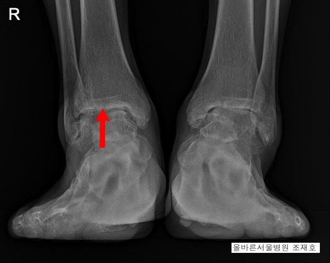 심한 발목 관절염에서 시행한 인공발목관절 치환술total Ankle Arthroplasty올바른서울병원 조재호 네이버 블로그