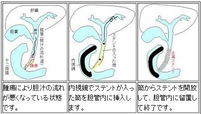 내시경적 검사치료 정리(ERCP, EST, ENBD, ERBD, PTBD) : 네이버 블로그