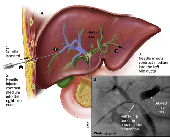 내시경적 검사치료 정리(ERCP, EST, ENBD, ERBD, PTBD) : 네이버 블로그