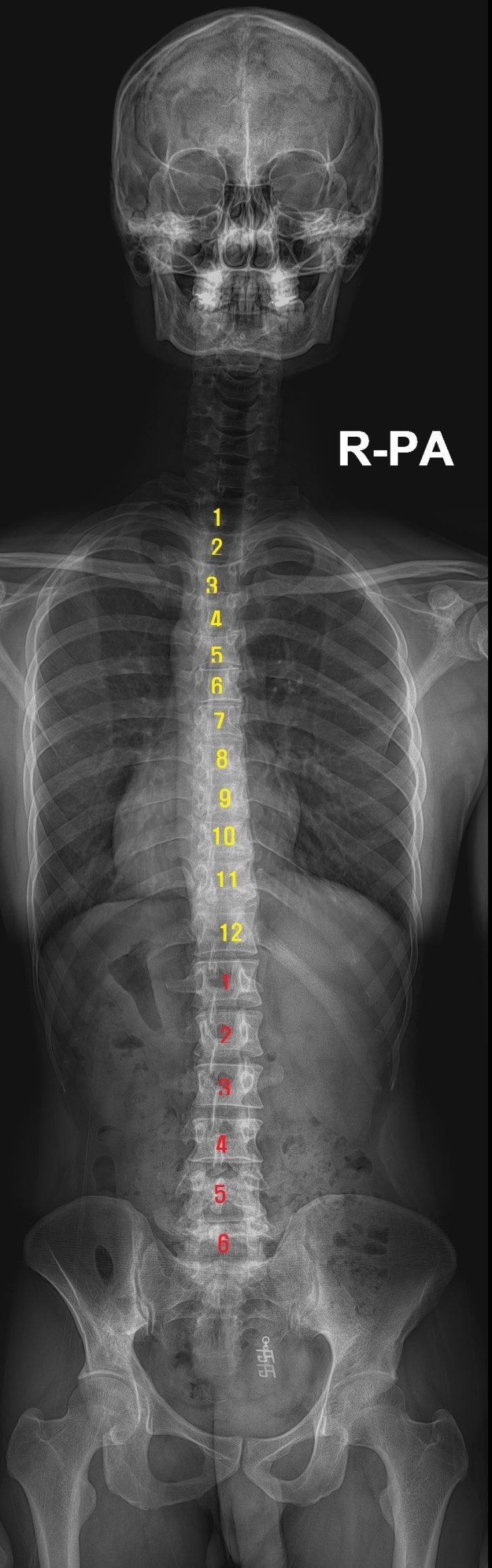 lumbosacral transitional vertebrae (LSTV: lumbarization and ...