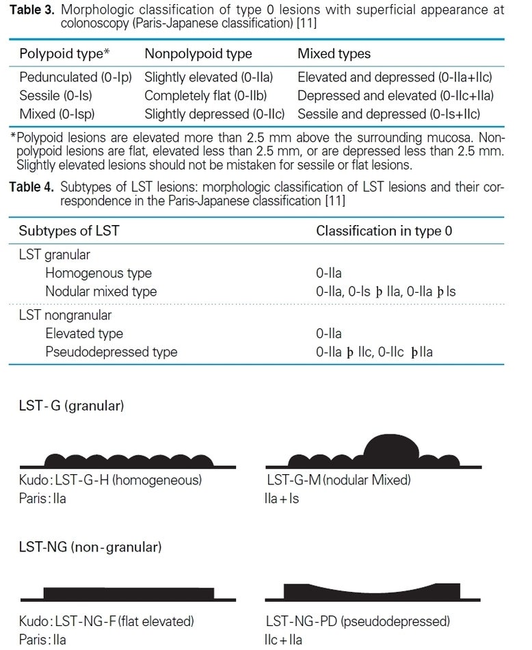 대장 용종 : 측방 발육형 종양(LST) : 네이버 블로그