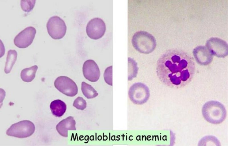 거대적혈모구빈혈(Megaloblastic anemia) : 네이버 블로그