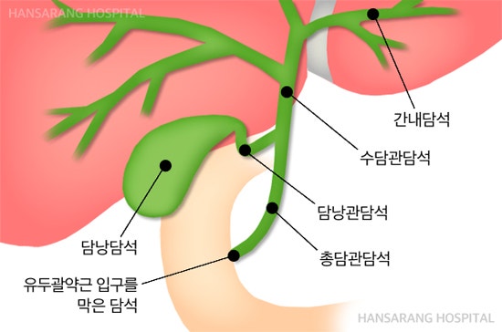ERCP; 내시경적역행성담췌관조영술, 담석제거, ERBD, ENBD : 네이버 블로그