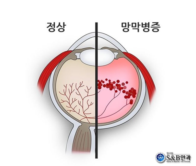 안질환에 따른 교육적 조치 네이버 블로그