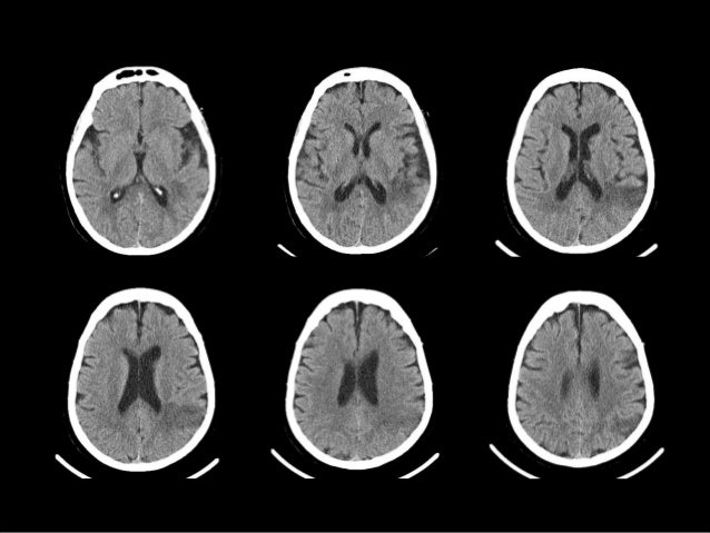 뇌실내출혈(intraventricular hemorrhage, IVH)과 수두증(hydrocephalus)에 대하여 : 네이버 블로그