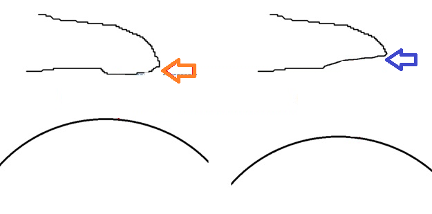 어깨힘줄파열 환자 중 견갑하근 파열에서 오구돌기 성형술(coracoplasty)이 필요한가 / 천안의료원 정형외과 어깨클리닉 ...