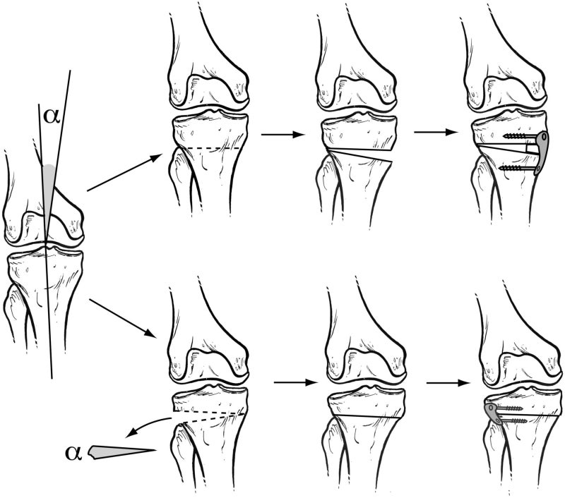 무릎 관절 절골술(High Tibia Osteotomy: HTO) : 네이버 블로그