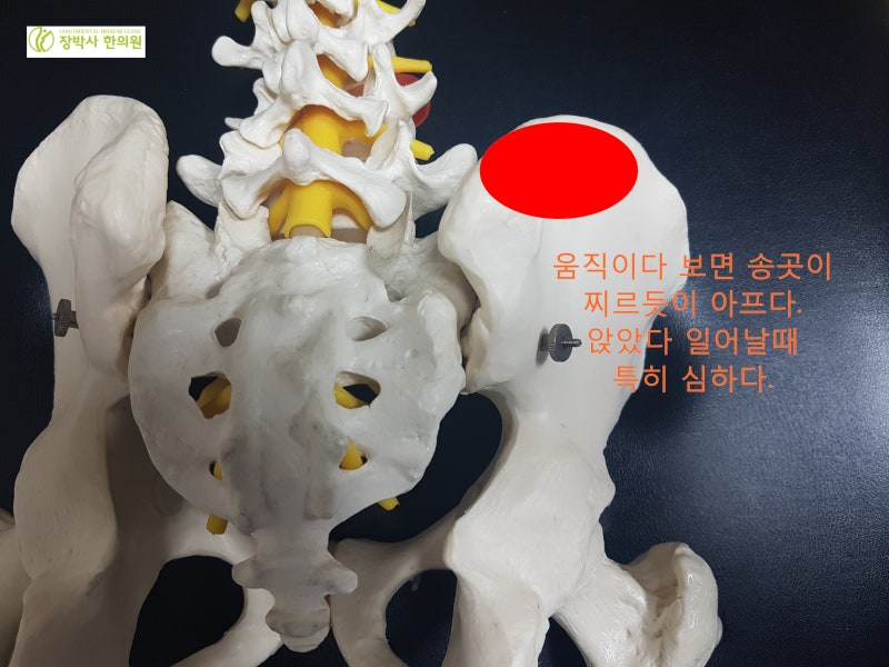 만성 요통 엉덩이 통증의 원인 흉요추 이행부 증후군의 증상 진단 치료 네이버 블로그