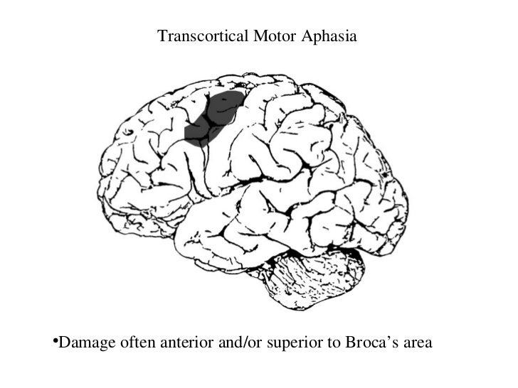 실어증(Aphasia)에 대하여 : 네이버 블로그