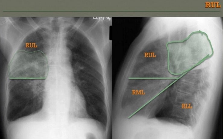 [KMLE] 폐렴 위치, Pneumonia, lung, lobe : 네이버 블로그