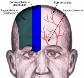 [수영하는 사람의 두통(swimmer's headache] 수영을 했더니 머리가 아파요?! 물안경을 조이는 것을 썼더니 수영하고 ...