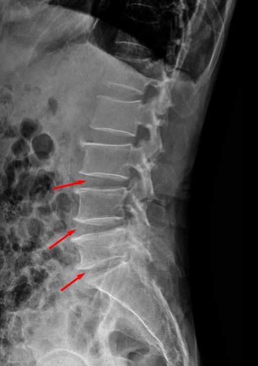 척추관 협착증(Spinal stneosis) 치료 중 미세현미경 감압술 (partial hemilaminectomy and ...