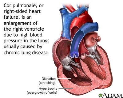 [의료&산재전문변호사] 진폐증의 합병증; 폐성심(cor pulmonale)이 무엇인가요? : 네이버 블로그