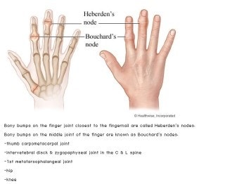 rheumatoid arthritis : 네이버 블로그