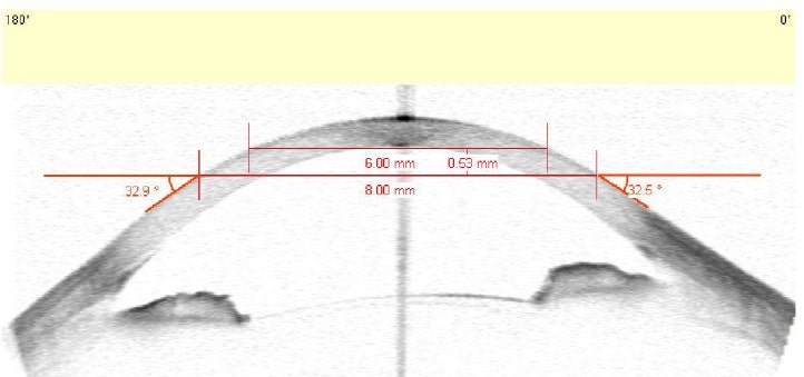 파라곤 CRT 드림렌즈에서 Visante OCT의 활용은? : 네이버 블로그