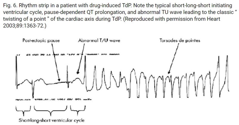 Polymorphic VT & Torsades de Pointes (TdP) : 네이버 블로그