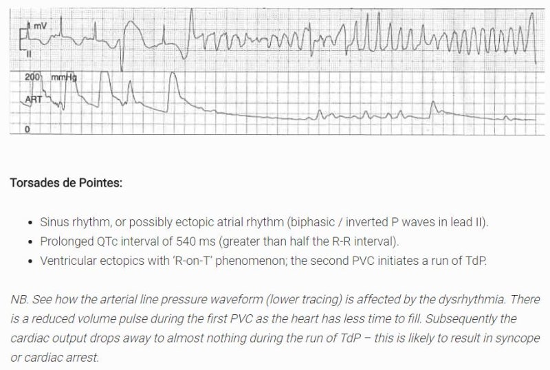 Polymorphic VT & Torsades de Pointes (TdP) : 네이버 블로그