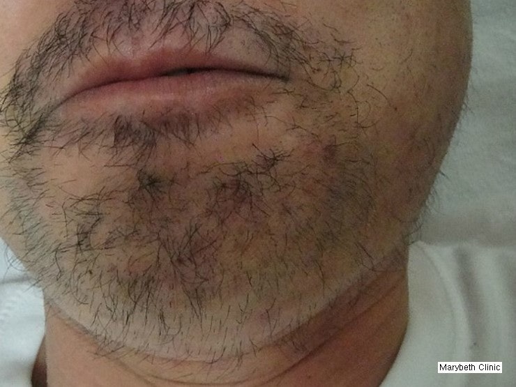 2. 수염백선증(鬚髮白癬, Tinea barbae) - 제12장. 백선증(白癬症, Dermatophytosis) - 한국에 흔한 ...