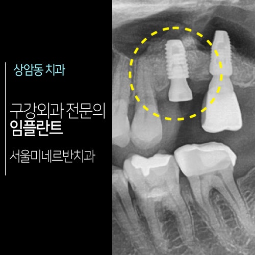 상암동 치과 구강악안면외과 전문의 원장님의 임플란트 특화진료 네이버 블로그