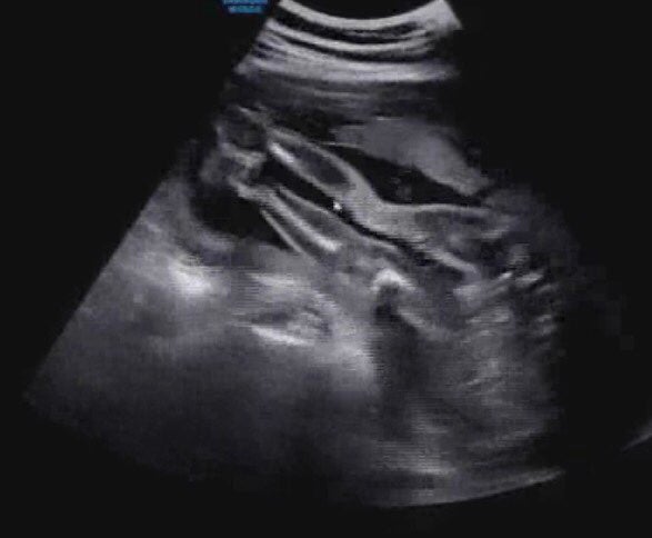 임신22주 기형아검사 정밀초음파 검사 통과 네이버 블로그
