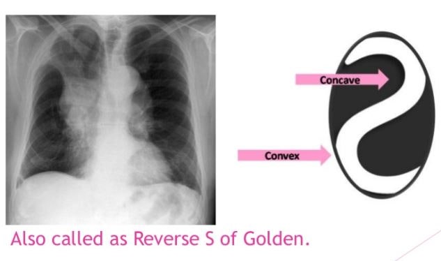 [Chest X-ray] 무기폐, 흉막삼출, 기흉 : 네이버 블로그