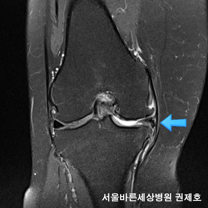 근위경골절골술 무릎관절염 진행을 막는 방법hto 네이버 블로그
