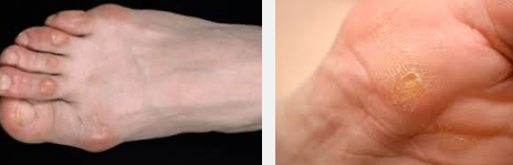 [목동 신정동 피부과 앤클리닉] 발바닥 통증 티눈(Corn, Clavus) 치료하기 : 네이버 블로그