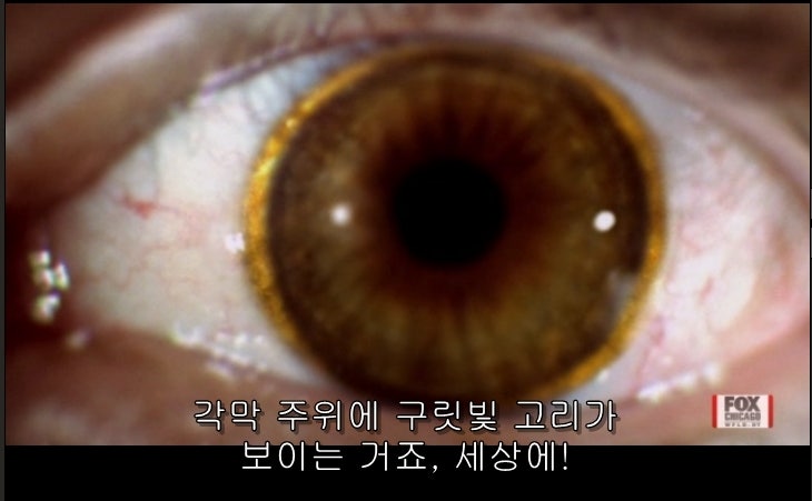 하우스 시즌1, 윌슨병, 카이저 - 플라이셔 링, Wilson disease, Kayser-Fleischer rings) [의학 ...