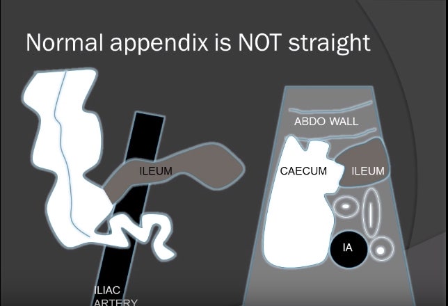 정상 충수, 초음파 소견, Normal appendix, ultrasound : 네이버 블로그