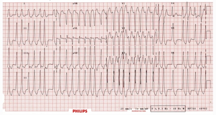 Atrial Fibrillation & Atrial Flutter in WPW : 네이버 블로그