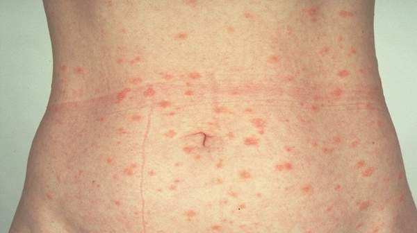 [용인, 수지, 풍덕천 제이앤지피부과] 장미색잔비늘증 (Pityriasis rosea) : 네이버 블로그