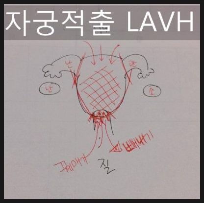 TLH와 LAVH의 차이점 이거안보면 어려울껄? : 네이버 블로그
