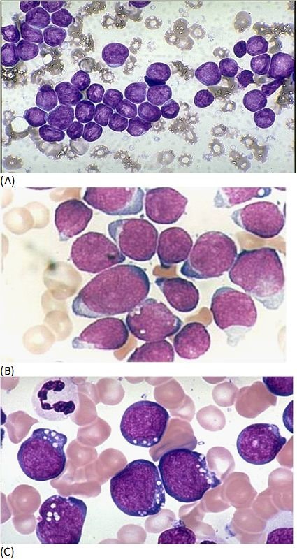 급성 림프모구 백혈병, Acute lymphoblastic leukemia ; ALL, 개요, 병리, 증상, 검사, 진단 ...