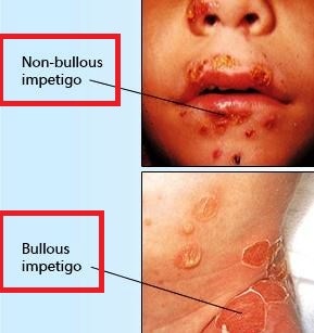 농가진 (impetigo) : 네이버 블로그