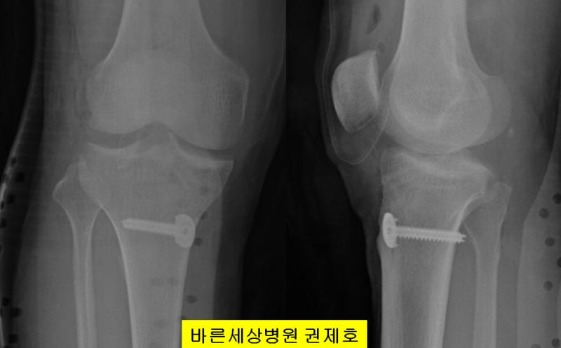 전방 십자인대 파열 회사에서 족구하는 중에 무릎에서 뚝 전방 십자인대 재건술 타가건 제이본정형외과 권제호 네이버 블로그