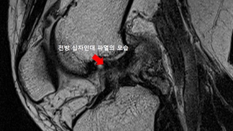 전방 십자인대 파열 회사에서 족구하는 중에 무릎에서 뚝 전방 십자인대 재건술 타가건 제이본정형외과 권제호 네이버 블로그