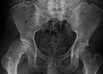 Legg-Calve-Perthes disease(LCP, 레그-칼베-페르테스 병, 소아 대퇴골두 무혈성 괴사) : 네이버 블로그