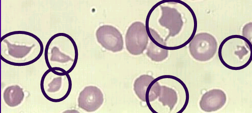 적혈구(RBC)의 형태, 크기, 염색성, 봉입체 : 네이버 블로그