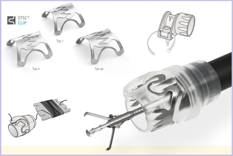 종양제거 내시경 시스템 (OTSC) : 네이버 블로그