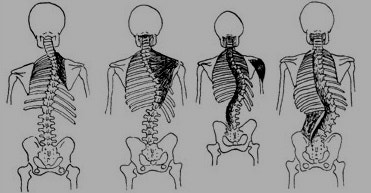 측만증개선 : 네이버 블로그