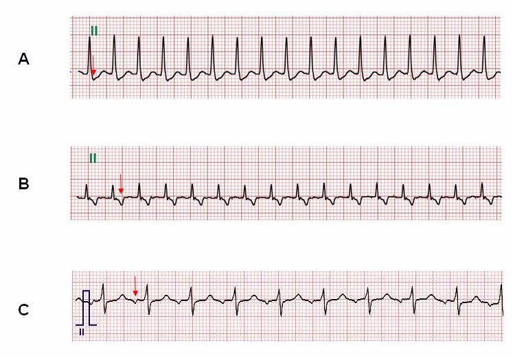 Short RP vs. long RP tachycardia : 네이버 블로그
