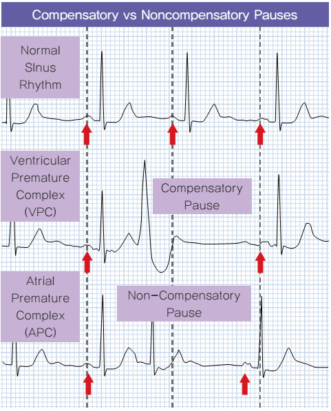 보상성 휴지기 (Compensatory Pause) : 네이버 블로그