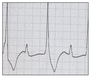 방실 차단 부정맥(실방 차단 부정맥) Atrioventricular block(Atrioventricular arrhythmia ...