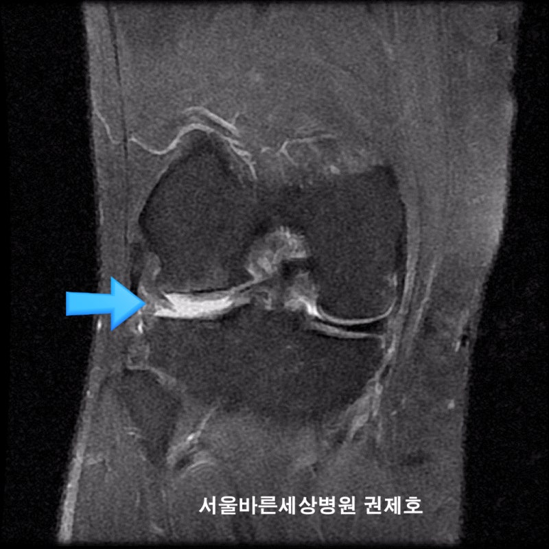 무릎절골술 외측 연골 손상에 대한 원위대퇴절골술 Dfo 네이버 블로그