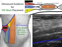 Transversus Abdominis plane block [초음파] : 네이버 블로그