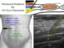 Transversus Abdominis plane block [초음파] : 네이버 블로그