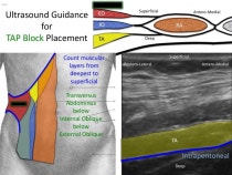 Transversus Abdominis plane block [초음파] : 네이버 블로그