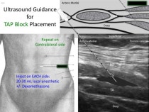 Transversus Abdominis plane block [초음파] : 네이버 블로그